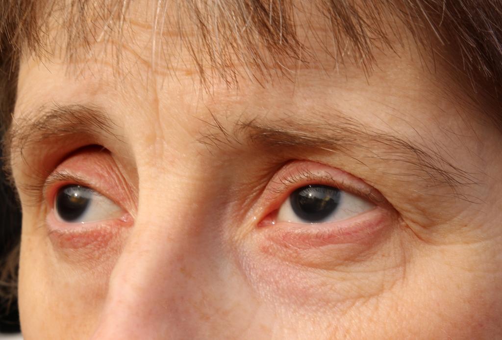 Rare Disease Day 2024 | Aniridia Network